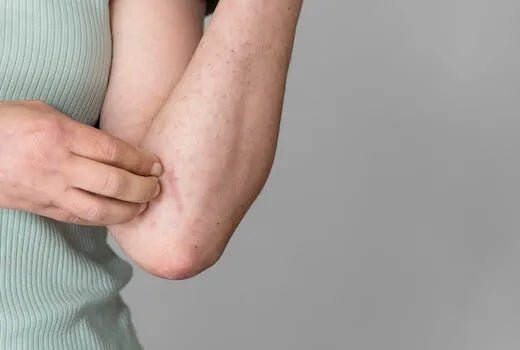 Mikä on Syyhy ja Miten Sitä Hoidetaan? – Apteekki 360